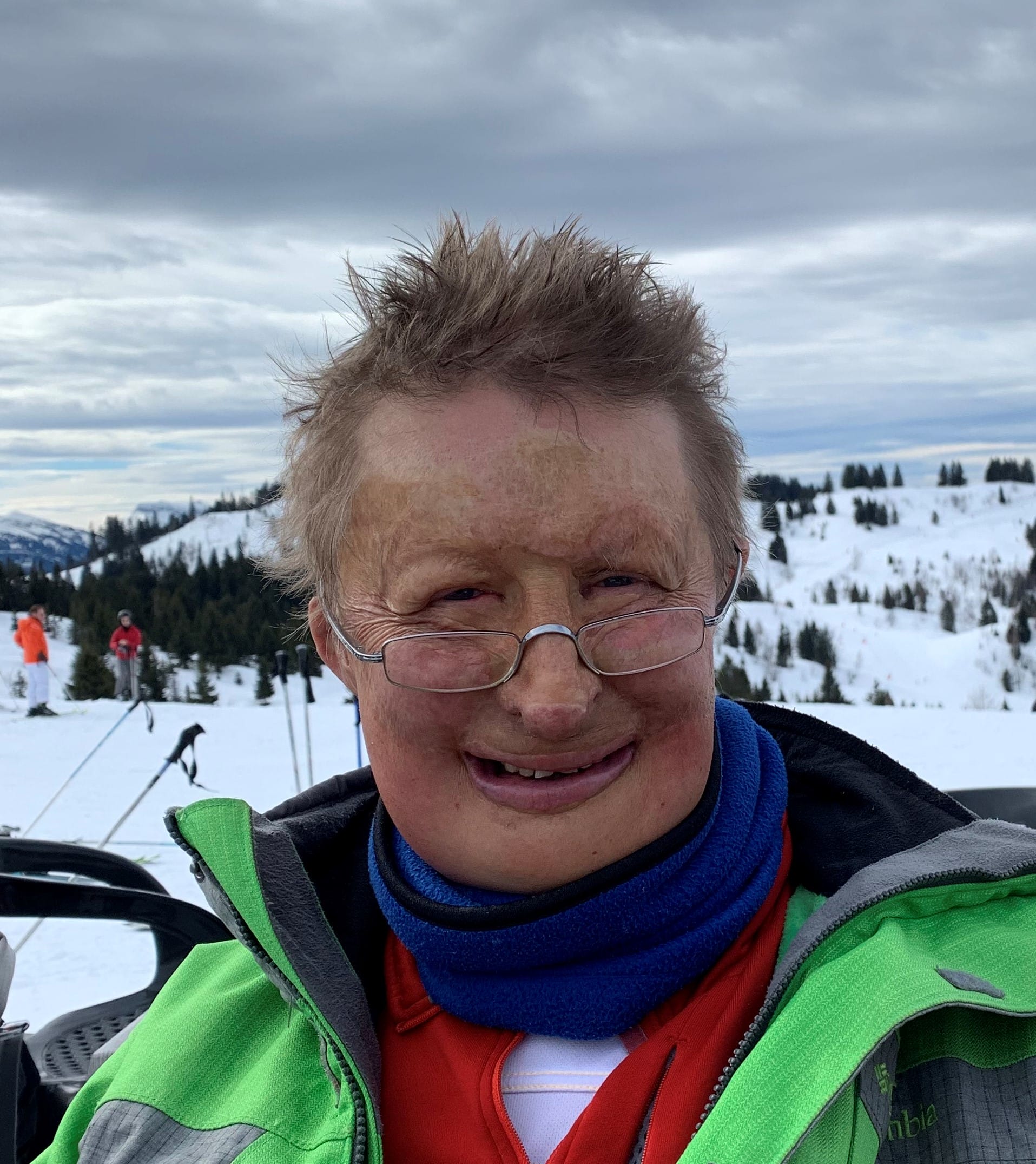 Q&A with James Partridge, author of ‘Face It’: Facial Disfigurement